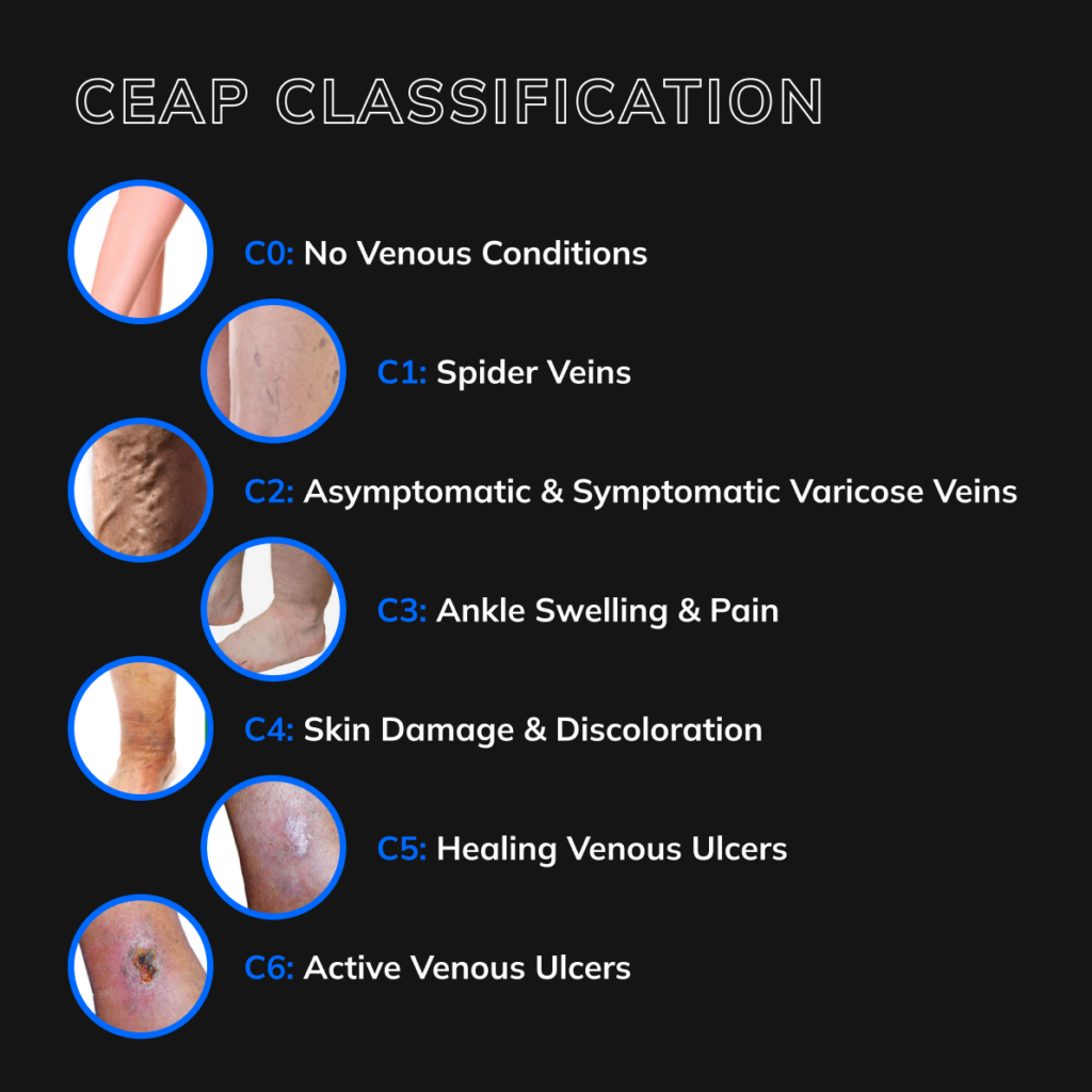 CEAP Classification in Rogers - Ozark Regional Vein & Artery Center