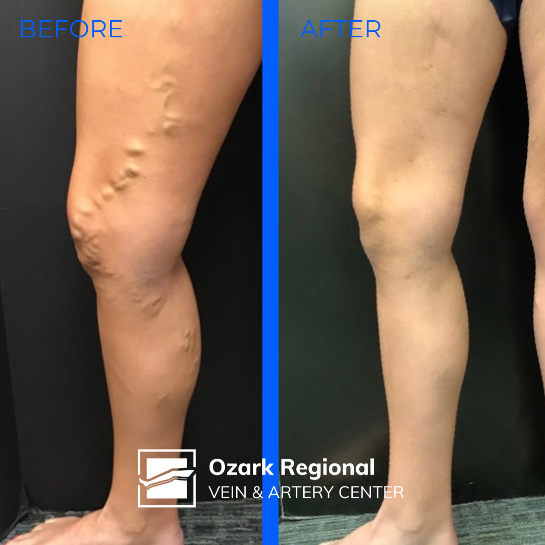 Before & After Gallery in Rogers - Ozark Regional Vein & Artery Center